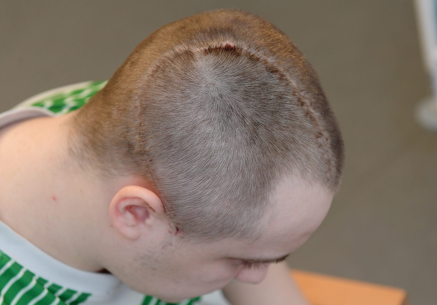 Chunk of skull removed from man after serious infection undetected by ...