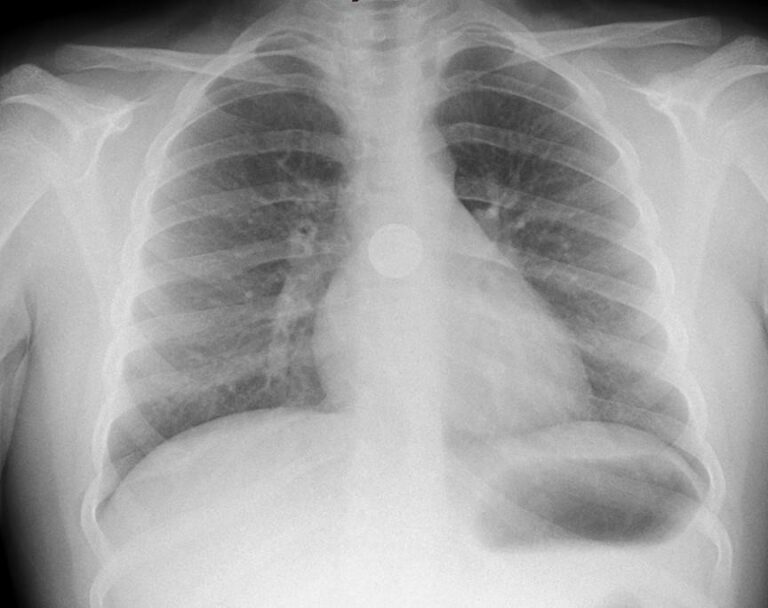 Warning as Glenrothes girl ends up in hospital after swallowing battery