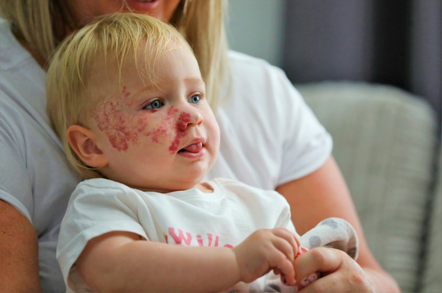How baby Willow born with face birthmark helps families in Tayside