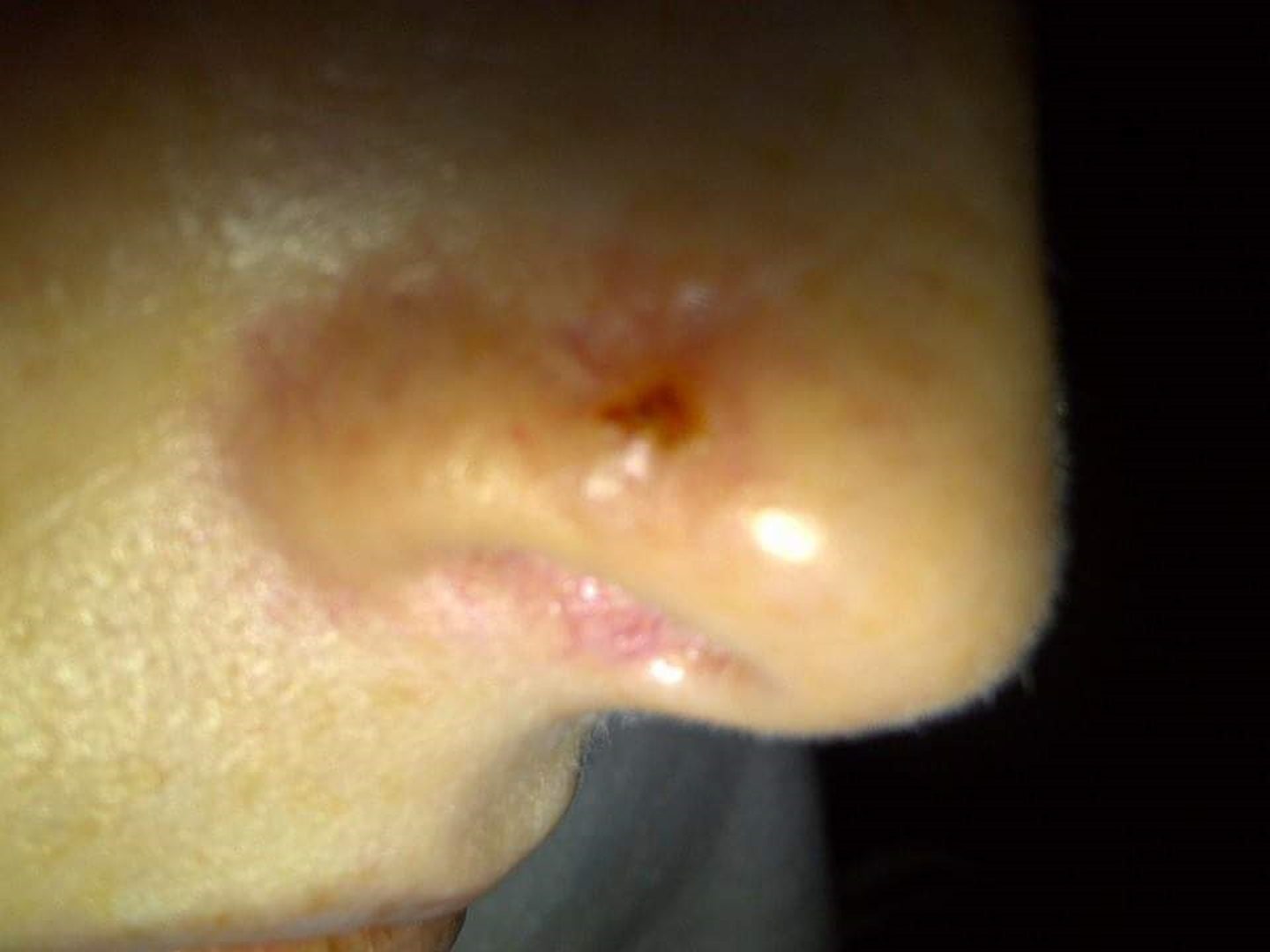 How Fife mum Donna's nose piercing triggered skin cancer