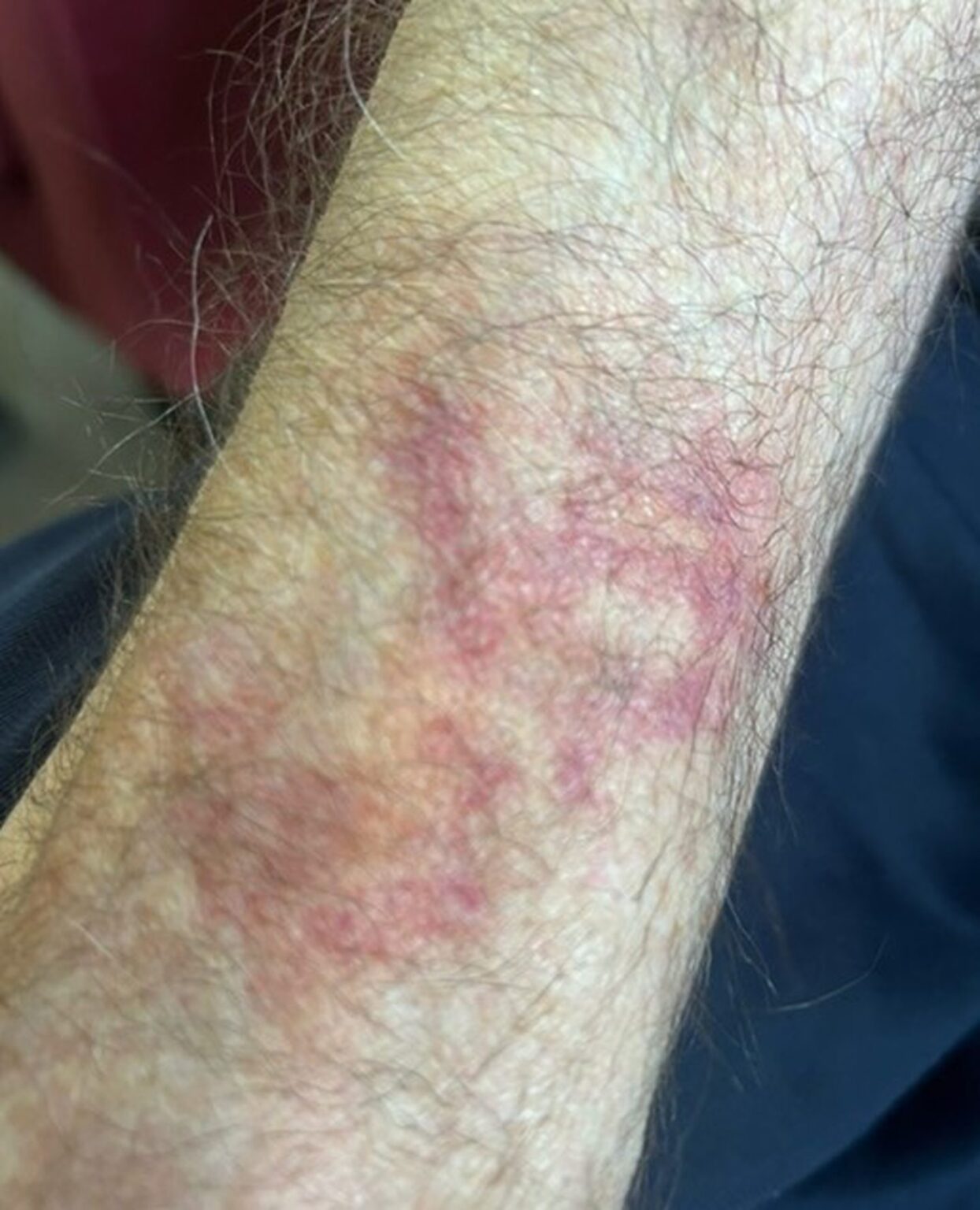 Resident had 'unexplained bruises' at Broughty Ferry care home