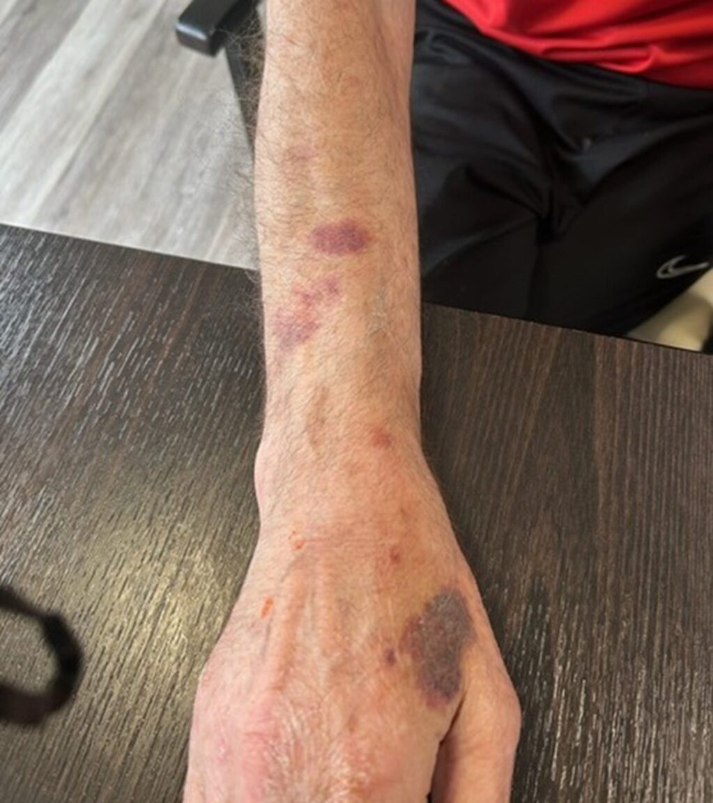 Resident had 'unexplained bruises' at Broughty Ferry care home