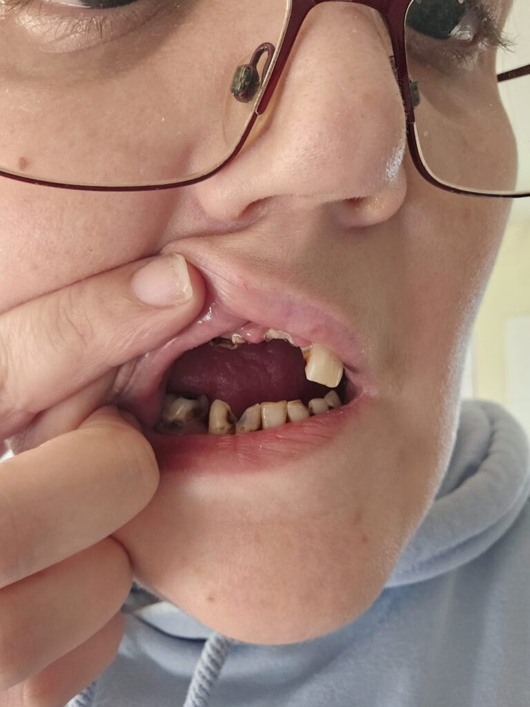 Dundee mum seeks new teeth after bulimia and pregnancies