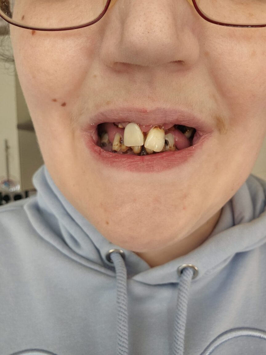 Dundee mum seeks new teeth after bulimia and pregnancies
