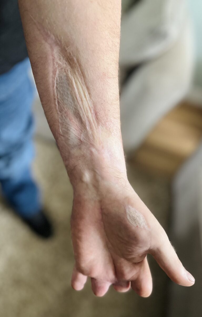 Payout for man who lost fingers in Dunfermline industrial accident