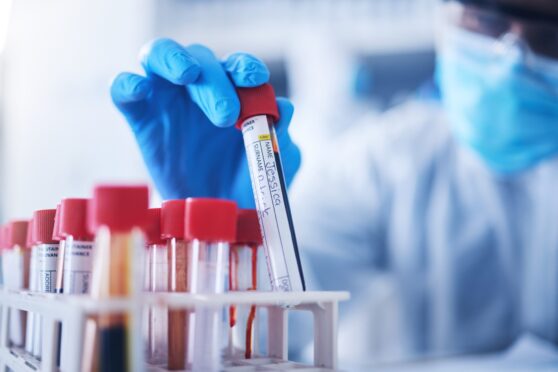 New test could give NHS extra weapon in prostate cancer battle