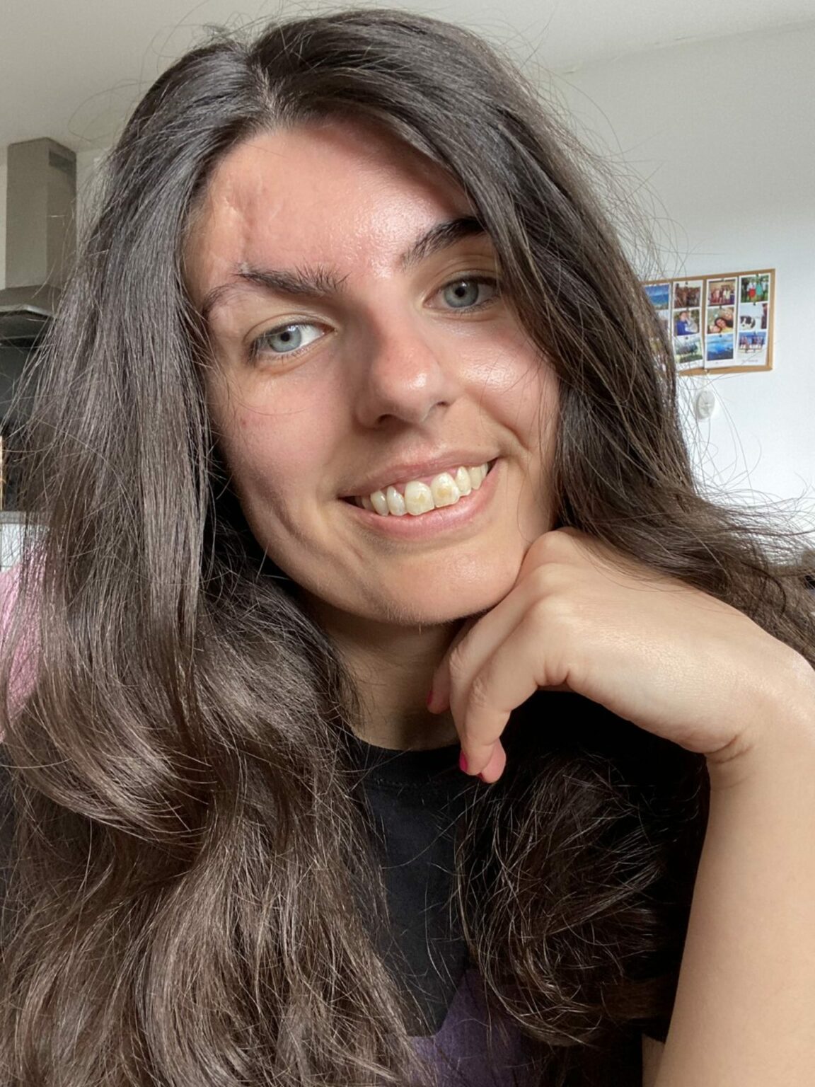 Living with visible differences: 3 women open up about their experiences