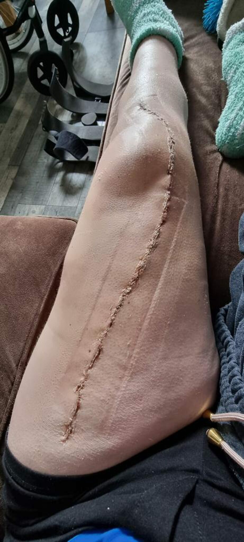 More than £14k donated for Moray youth worker's bone cancer fight