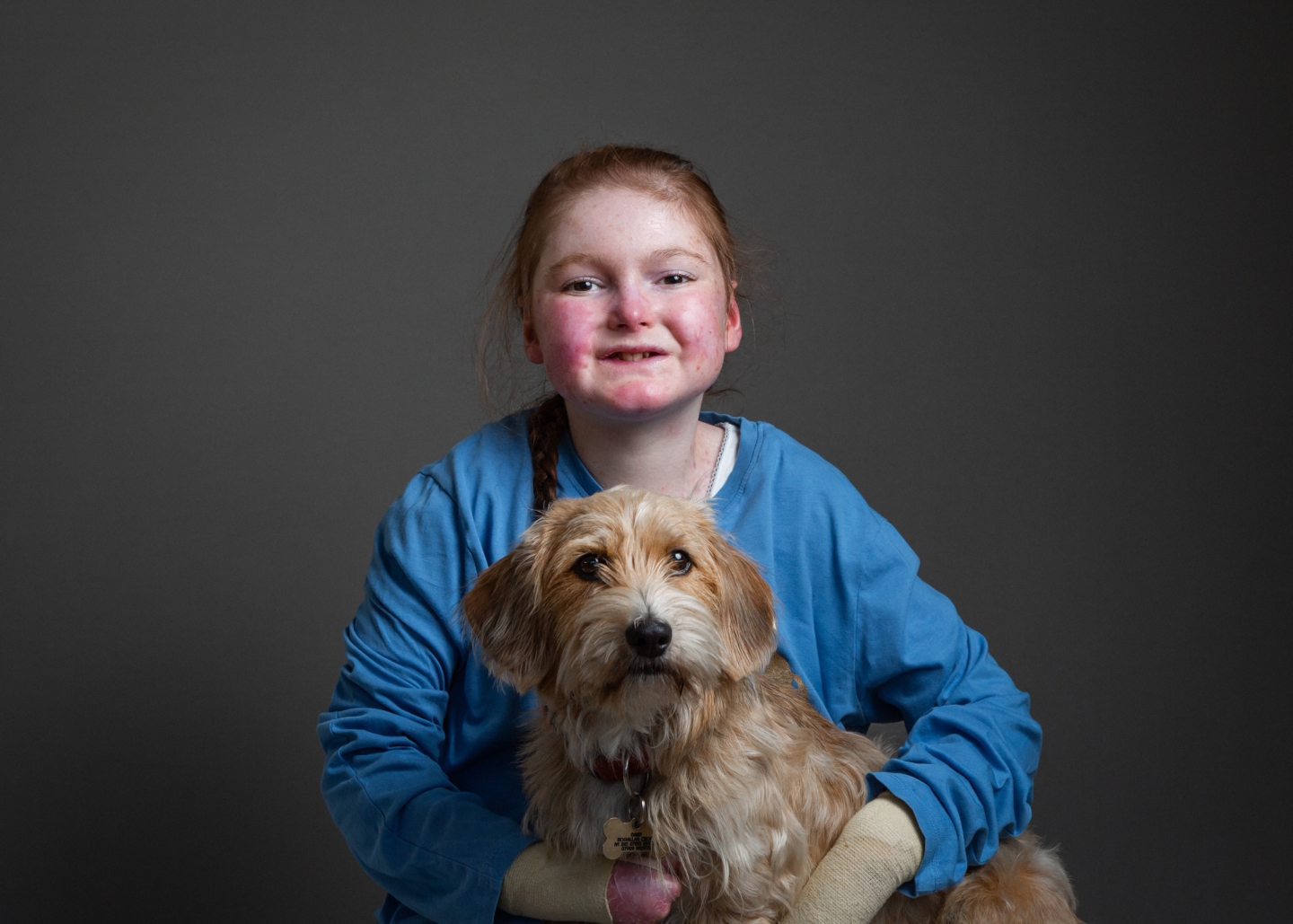 Graeme Souness shocked by Inverness 'butterfly skin' teen's '60 surgeries'