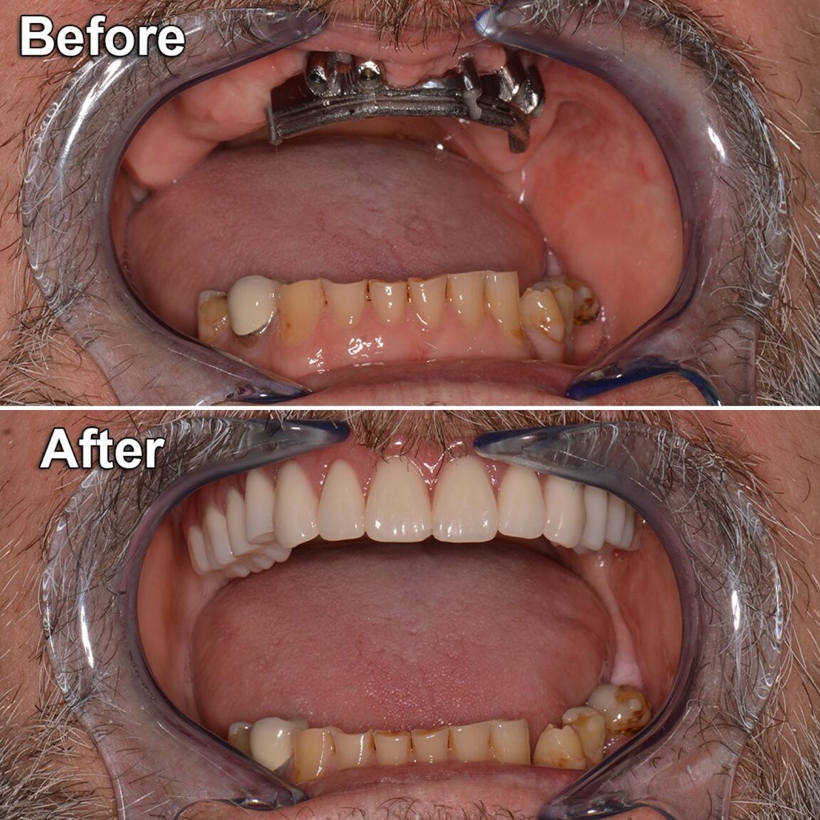 Dental implants in Aberdeen are changing the lives of many