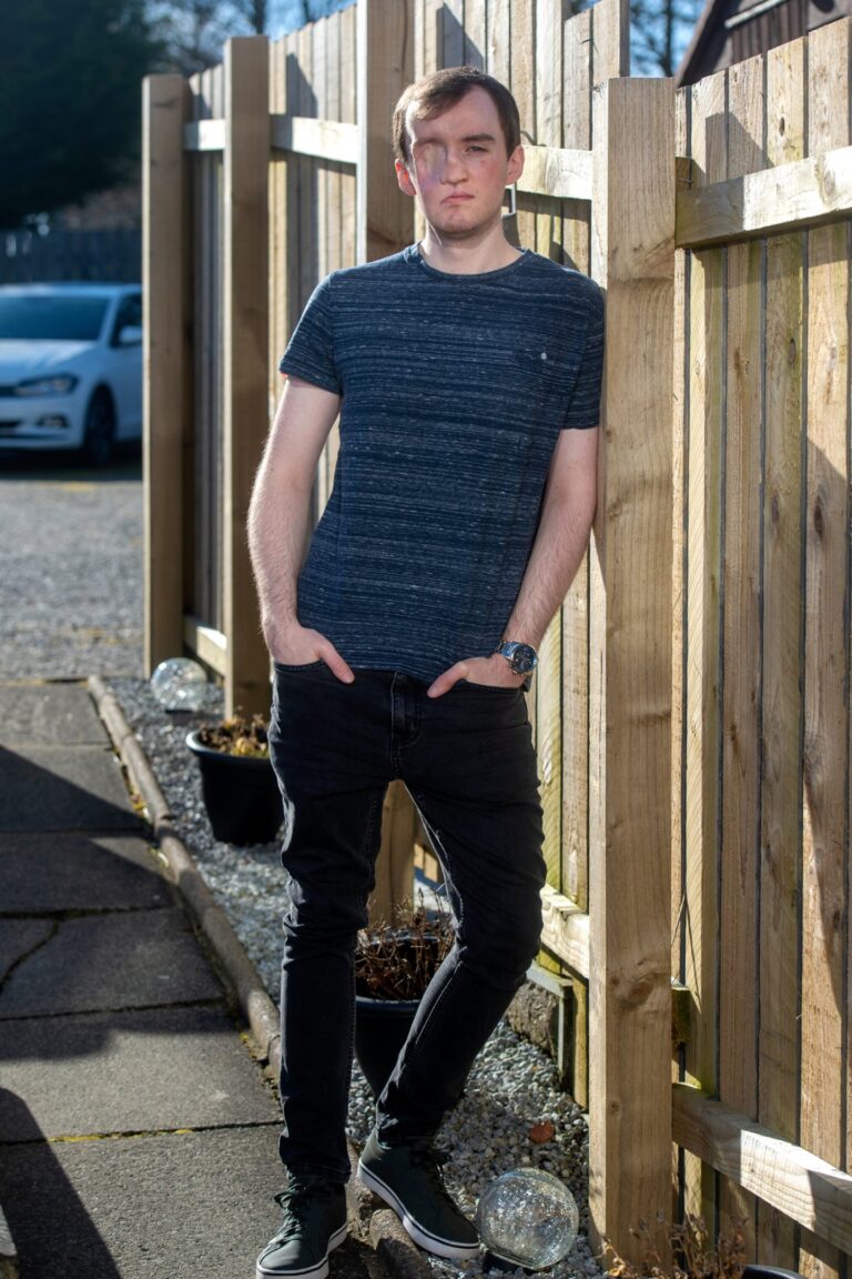 Bridge of Don's Aiden: Cancer took my eye, now I'm a comedian