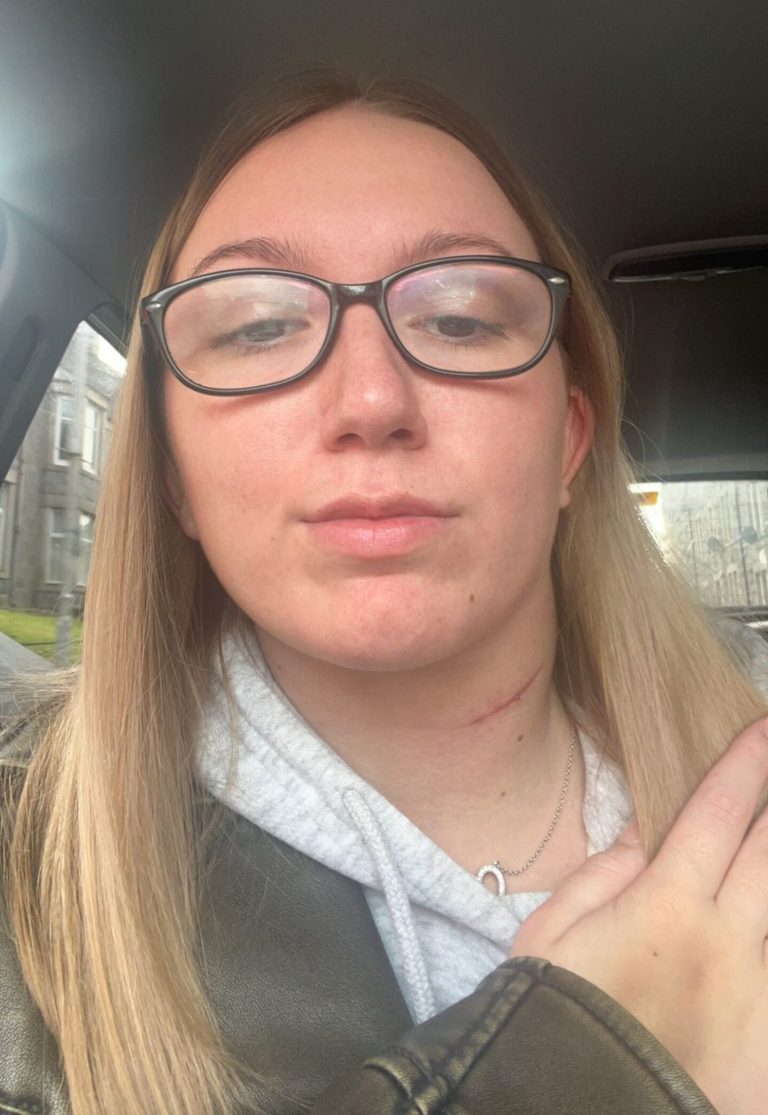 Chloe Reid from Aberdeen in remission after cancer diagnosis at 21